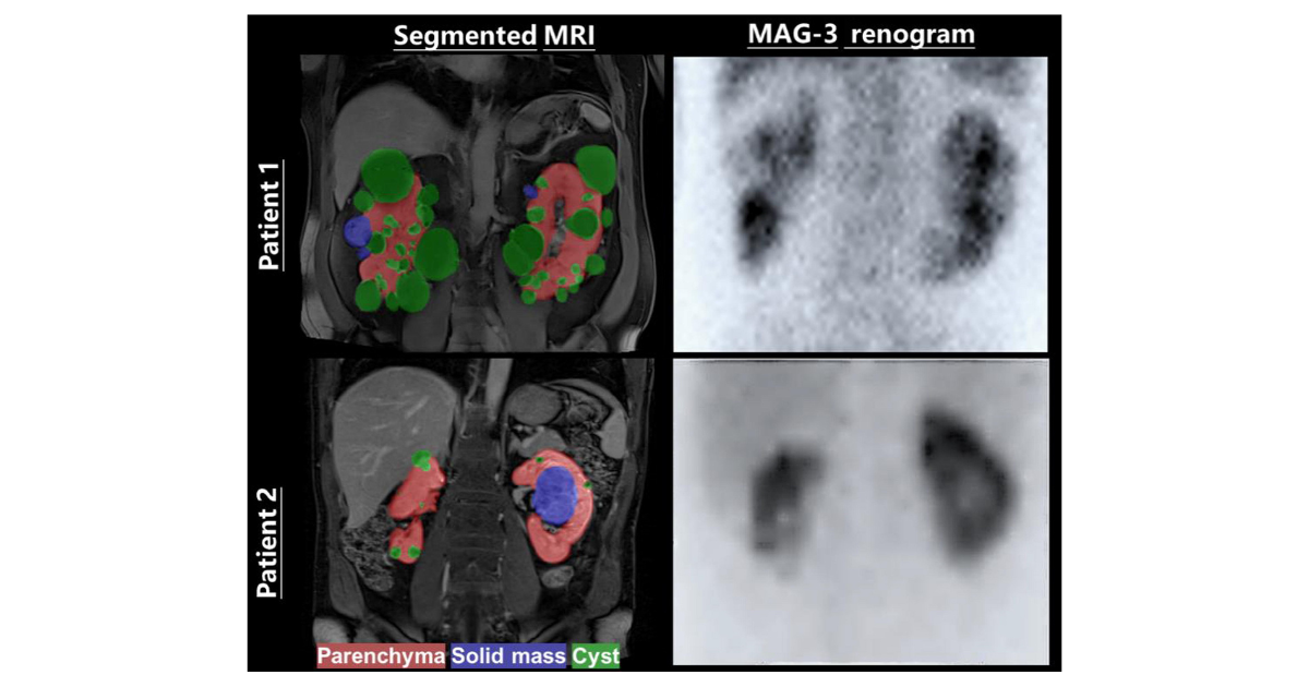 Preoperative renal parenchyma volume as a predictor of kidney function ...