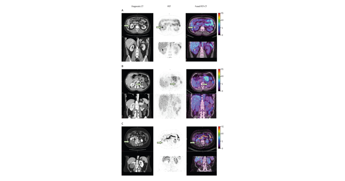 [89Zr]Zr-girentuximab for PET–CT imaging of clear-cell renal cell ...