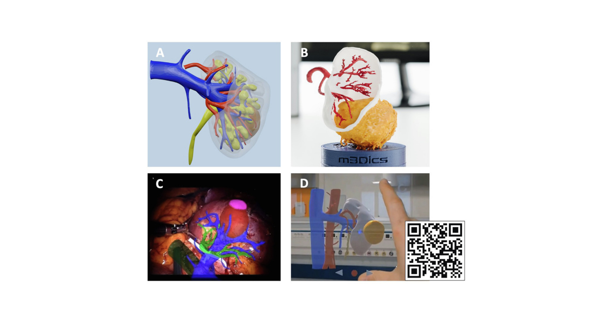 Three-dimensional model-assisted minimally invasive partial nephrectomy ...
